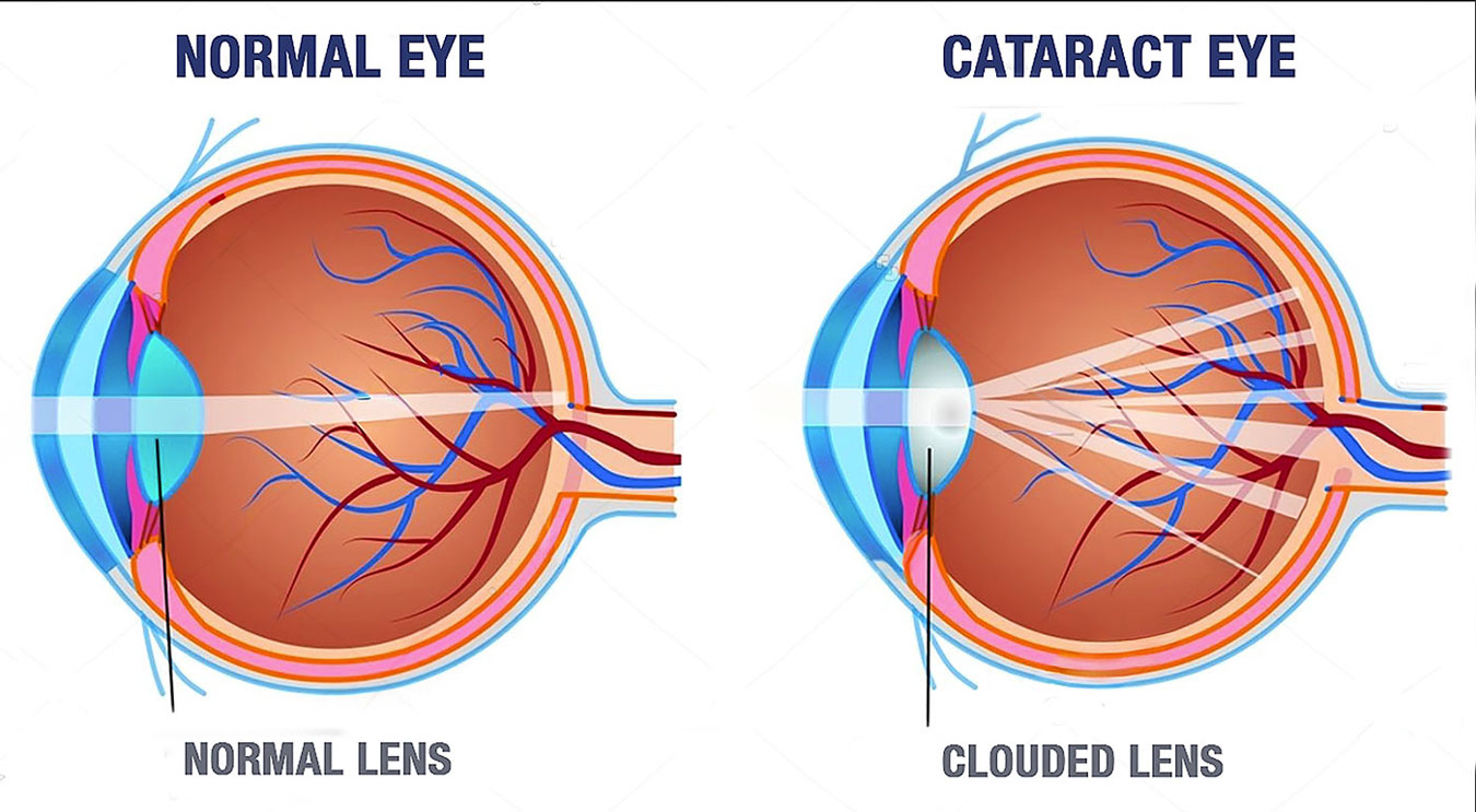 Early Signs of Cataracts | Wellish Abrams Vision Institute