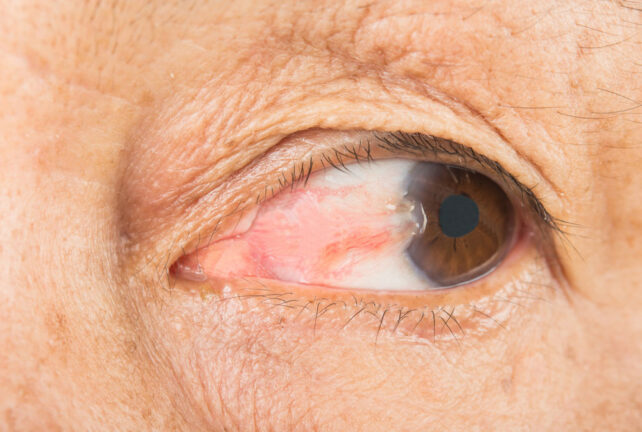 Pterygium Surgery in Las Vegas | Removal & Treatment