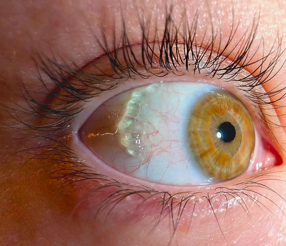 Bump On Your Eye, Types of Growths and Treatments
