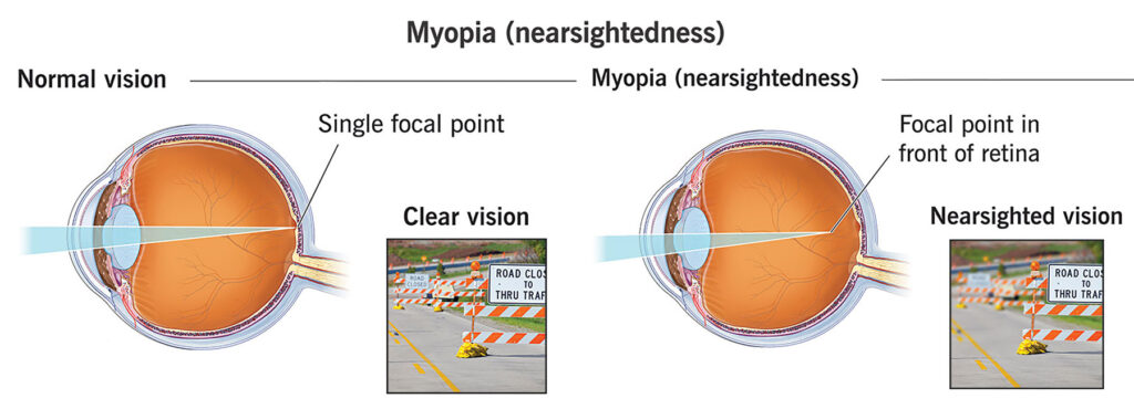 Myopia treatment: Symptoms and Options | WAVI