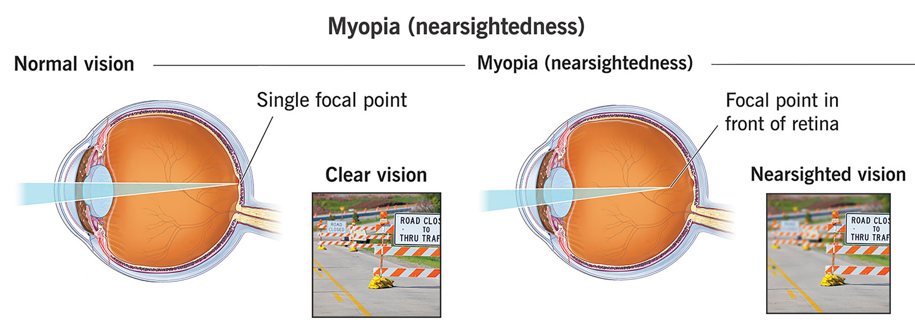 Myopia treatment: Symptoms and Options | WAVI